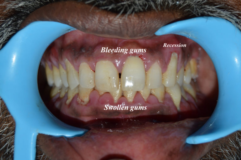 Early Signs of Gum Disease – DT Smile Care